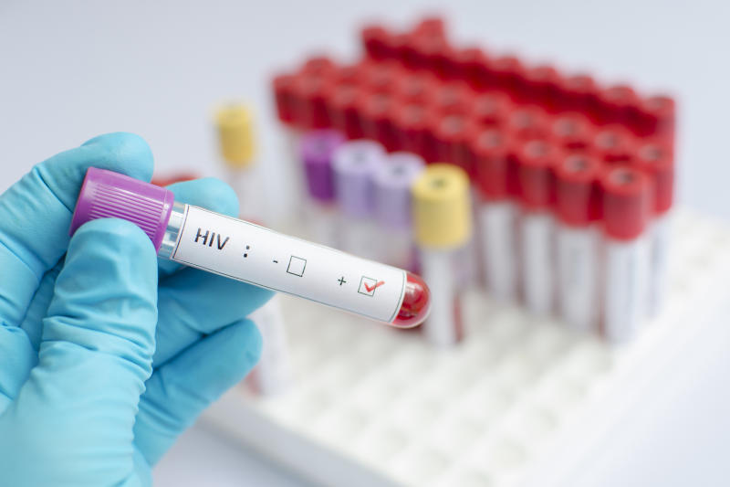 Rare genetic mutation shows stem cell therapy can block HIV infection ...